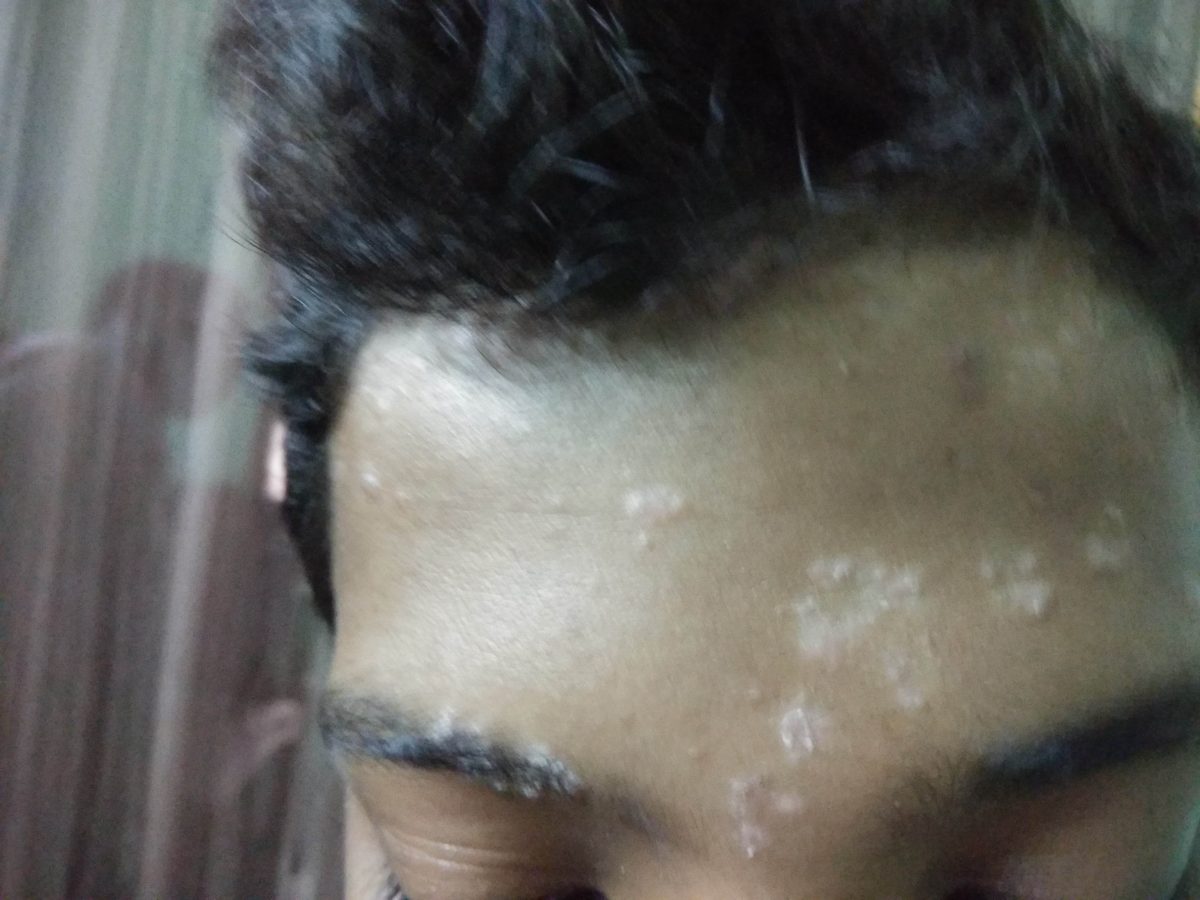 Facial Psoriasis Treatment: Causes, Symptoms and Remedies