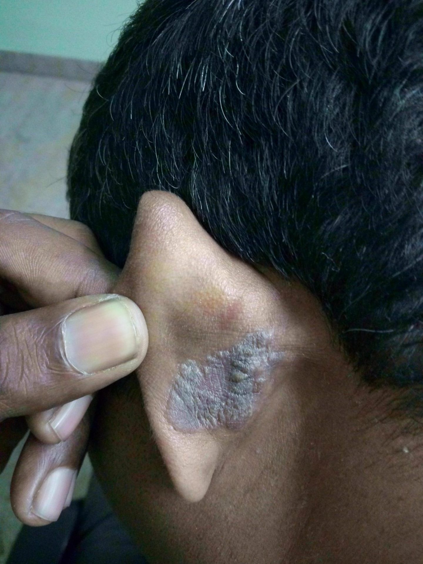 Psoriasis Behind the Ear: Ayurvedic Remedies and Treatments