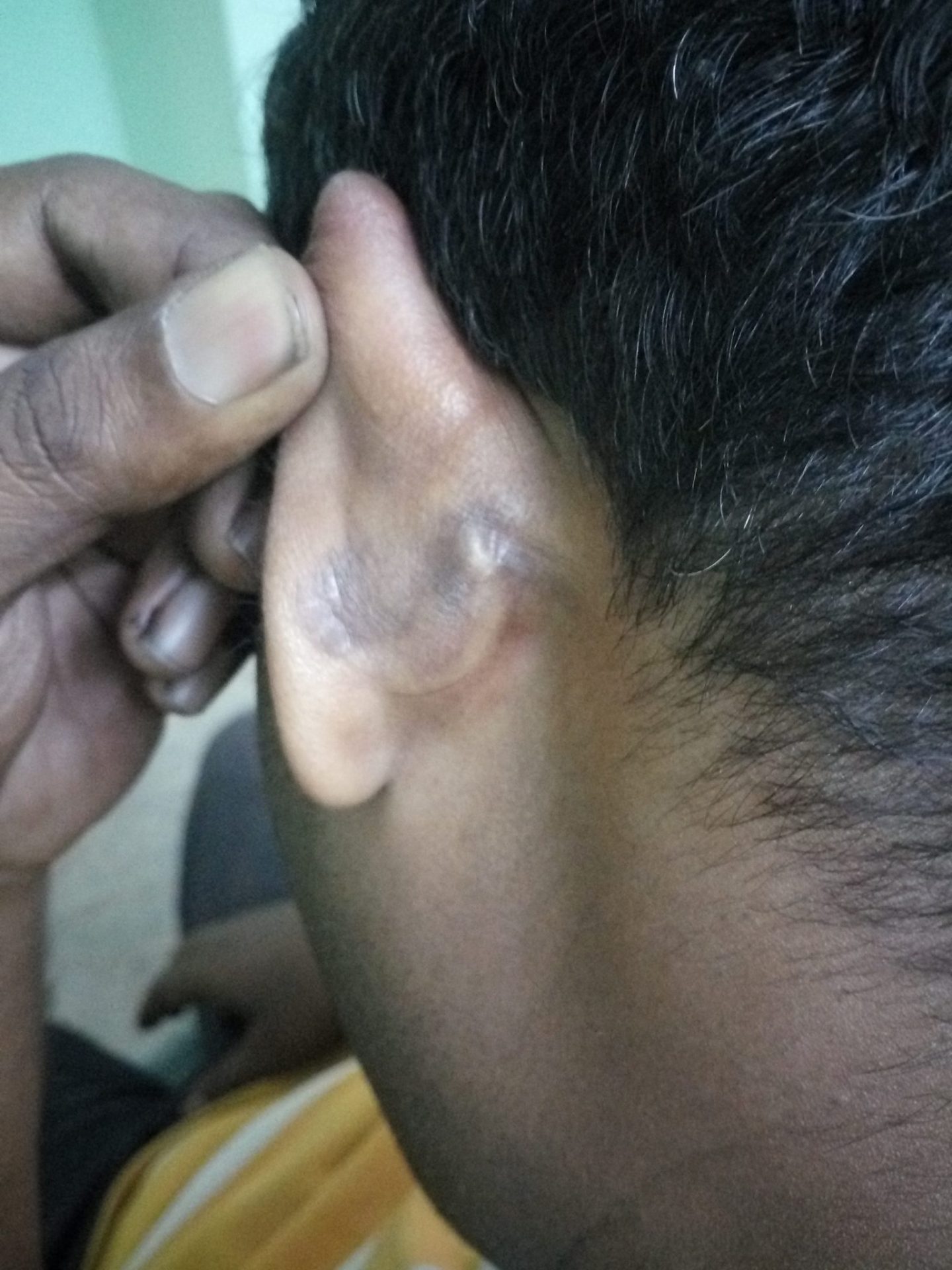 Psoriasis Behind the Ear: Ayurvedic Remedies and Treatments