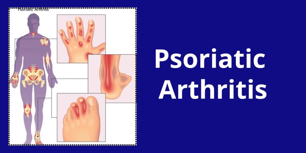 Psoriatic Arthritis - Symptoms, Causes and Treatment
