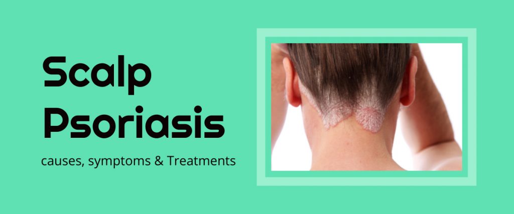 Scalp Psoriasis Treatment - Causes, Symptoms & Management