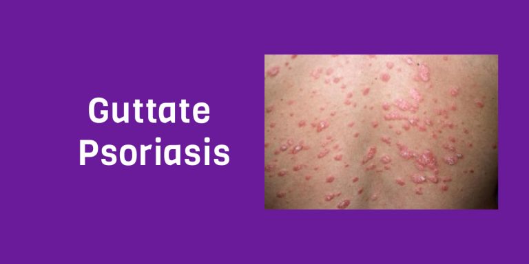 Guttate Psoriasis - Signs, Symptoms and Treatment