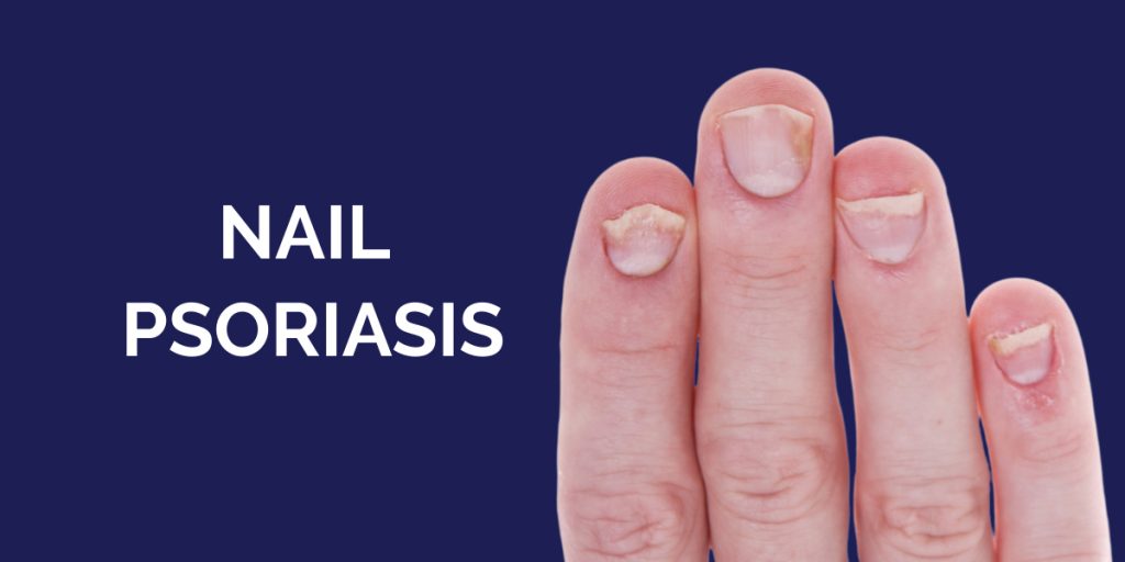 Nail Psoriasis Treatment in Bangalore | Ayurvedic Solutions