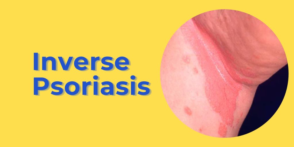Inverse Psoriasis Treatment: Best in Bangalore
