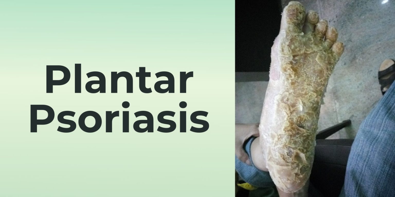 Plantar Psoriasis | Feet Psoriasis: What You Must Know