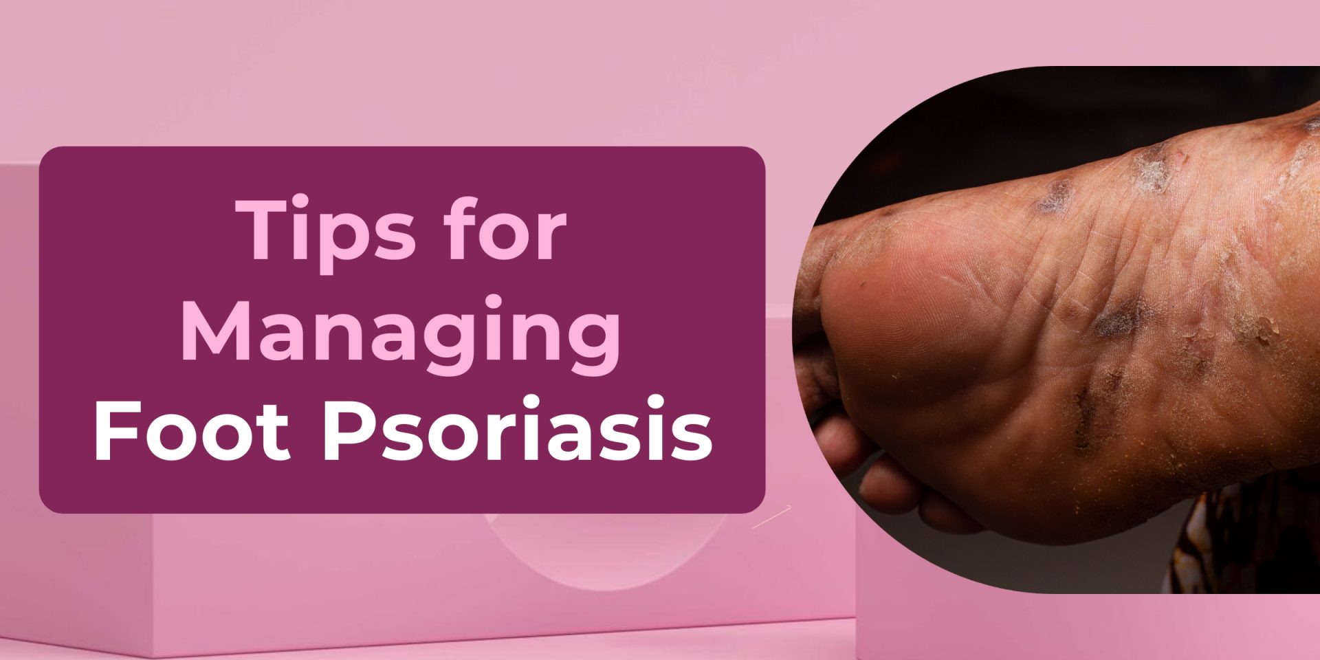 Home Remedies for Foot Psoriasis: Effective Tips & Solutions