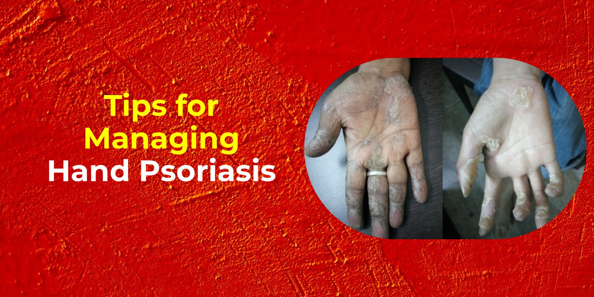Hand Psoriasis Treatment: Symptoms and Tips for management