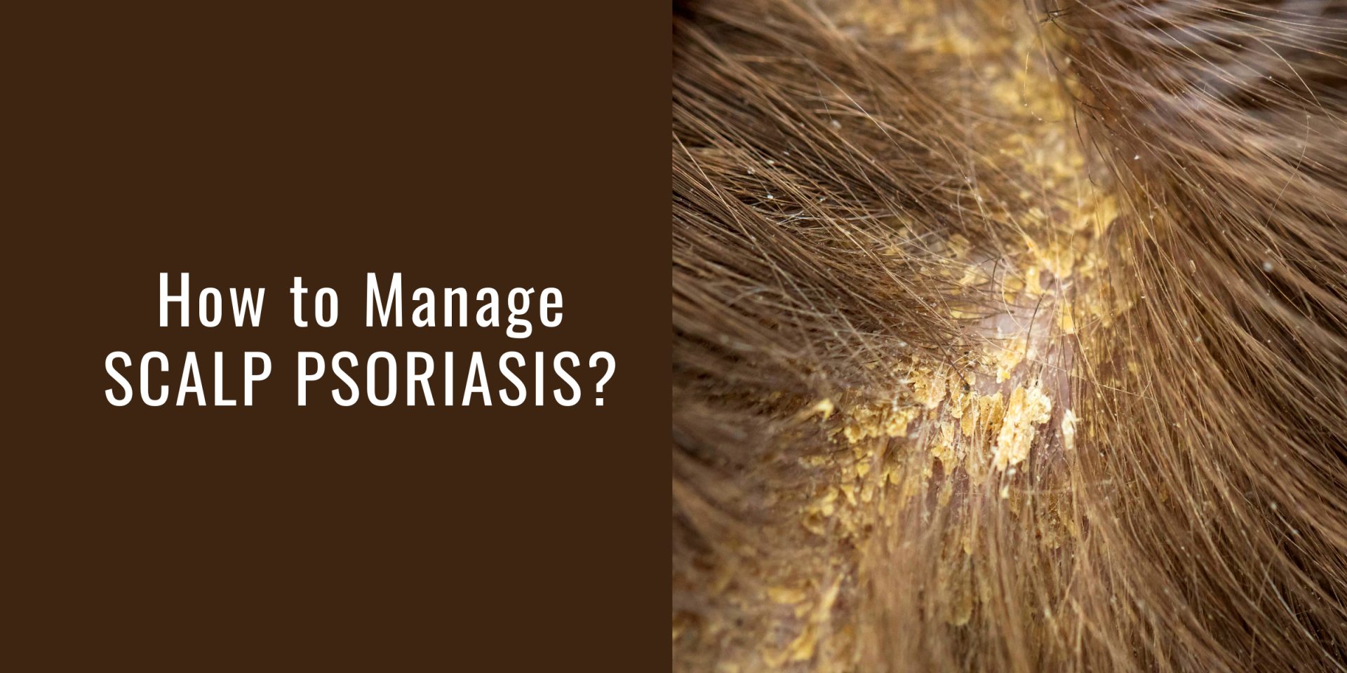 Management Of Scalp Psoriasis: Treatments And Practices