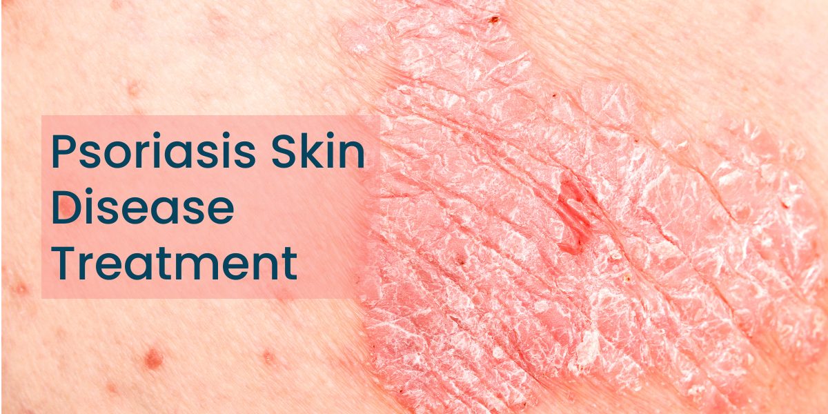 Understanding Psoriasis Skin Disease Treatment