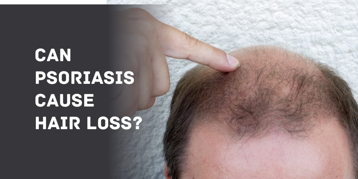 Can Psoriasis Cause Hair Loss? Unpacking The Connection