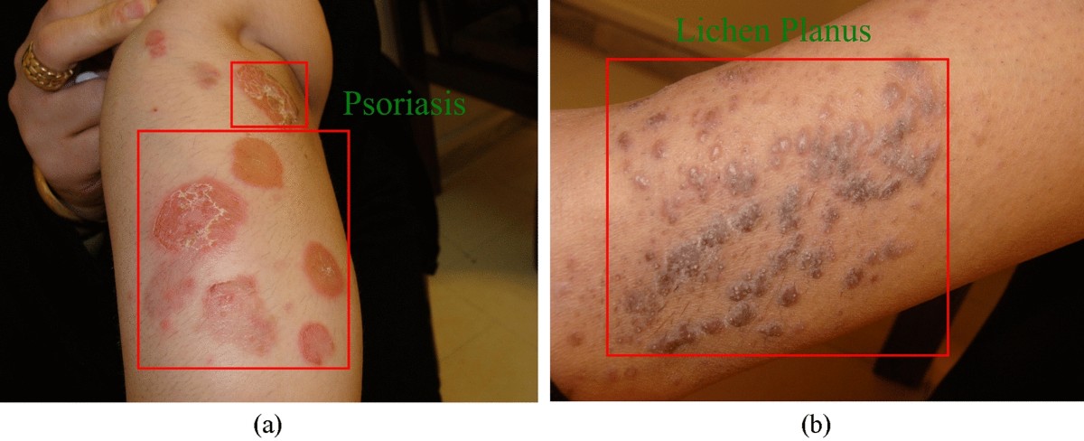 Lichen Planus vs Psoriasis: Key Differences & Treatment Guide